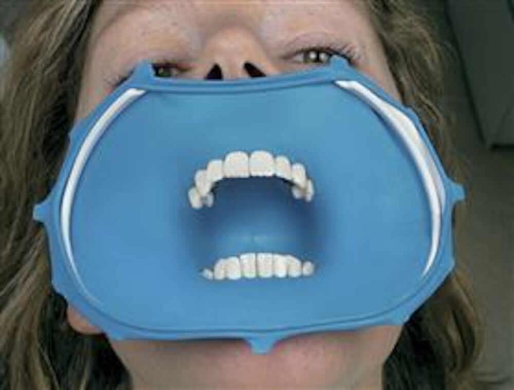 OptiDam Anterior refill 1 x 30 st — SE1